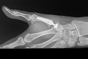 Thumb CMCJ replacement surgery testimonial | Cromwell Hospital